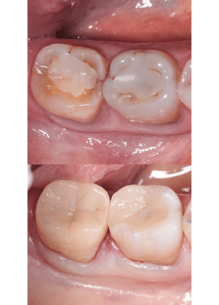 Dental Crown - East Peak Dental - Learn how Biomimetic Dentistry is Better!