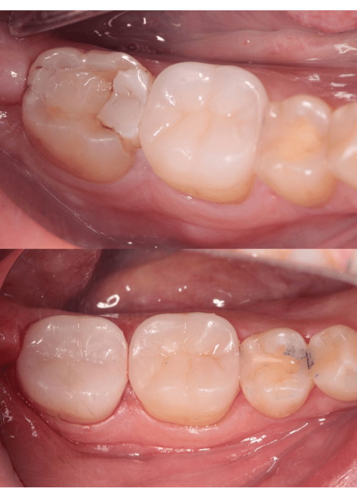 Dental Crown - East Peak Dental - Learn how Biomimetic Dentistry is Better!