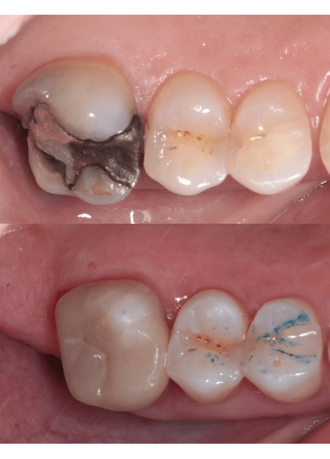 Biomimetic Dentistry - East Peak Dental